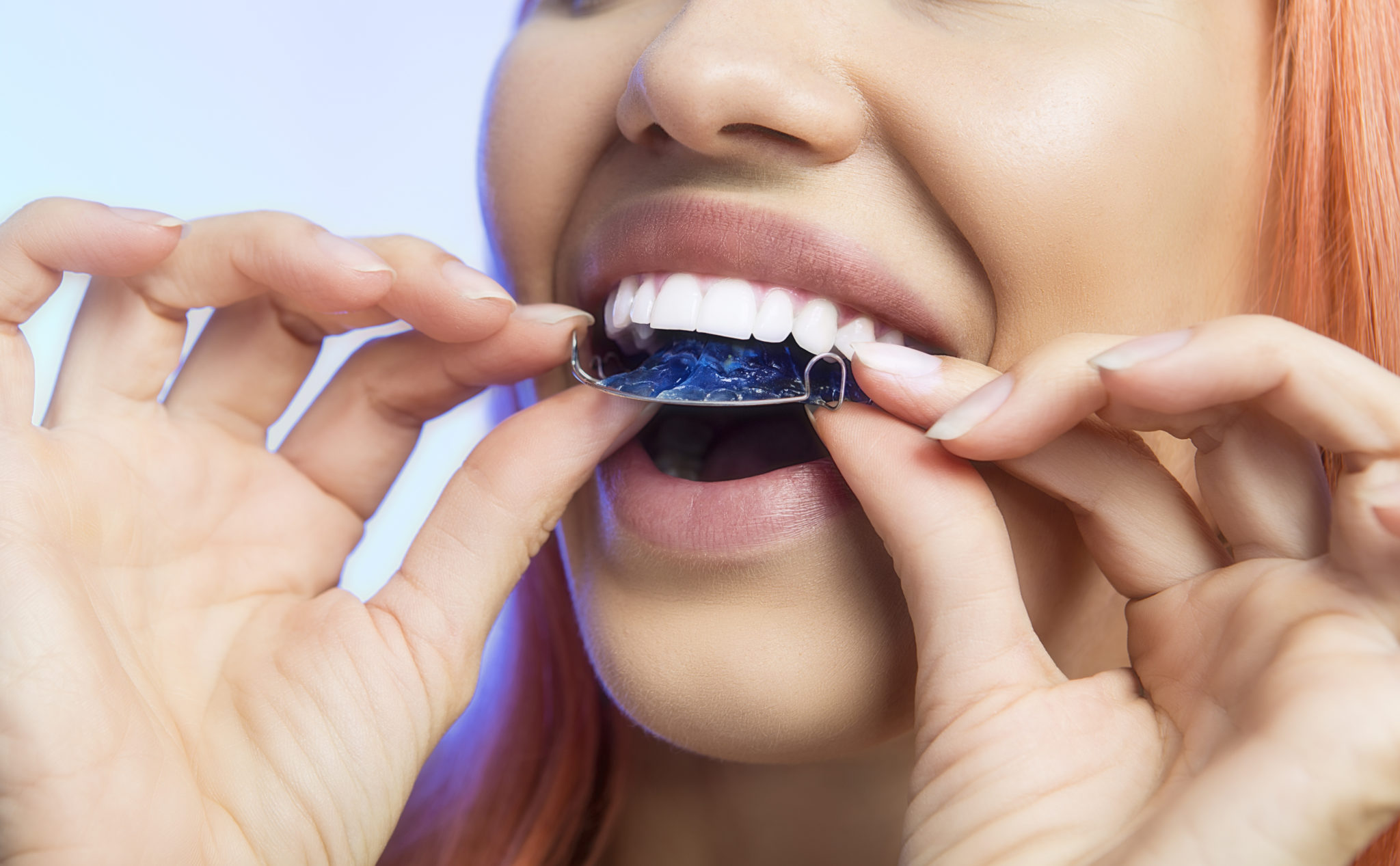 Permanent vs Removable Retainers: What's the Difference? - Swan ...